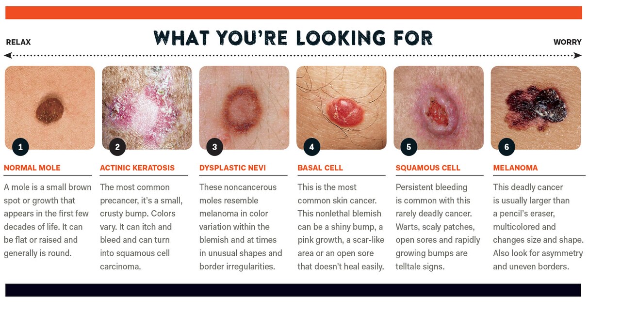【ベストコレクション】 Age Spots Vs Skin Cancer Pictures 200344 How Do You Tell The Difference Between Age